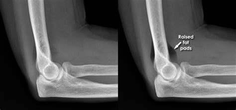 Elbow X Ray Fracture
