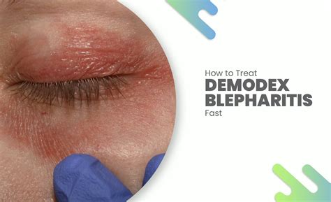 How To Treat Demodex Blepharitis Fast What Nobody Tells You About This