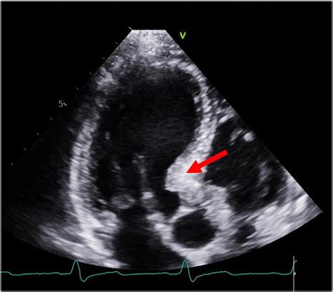Transthoracic Echocardiogram Apical Long Axis View Sigmoid Septum Download Scientific Diagram
