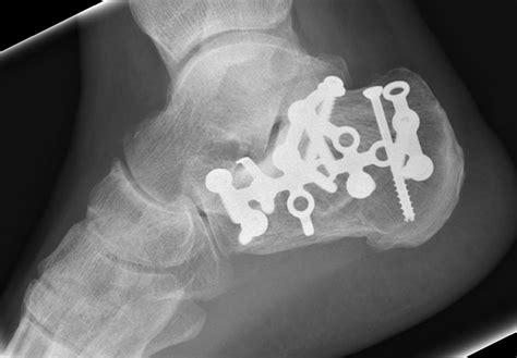 Management Intra Articular Fractures The Bone School