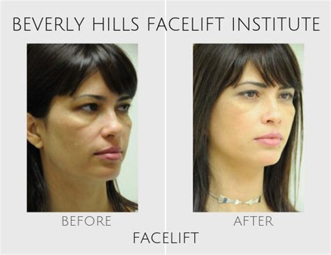 Look More Youthful Without A Lengthy Recovery Beverly Hills Facelift