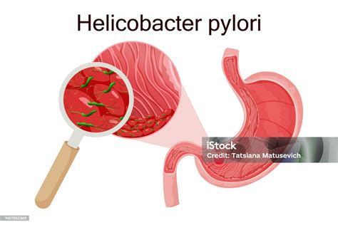 돋보기 아래 위장에서 헬리코박터 파일로리에 의한 위염 자세한 벡터 그림 내부에 대한 스톡 벡터 아트 및 기타 이미지 내부