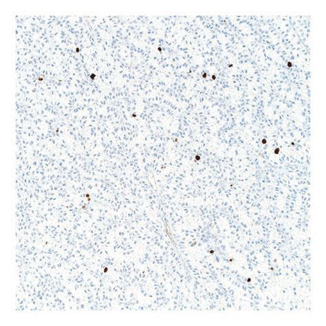 A Thyroglobulin Stain Negative B Focally Weakly Positive
