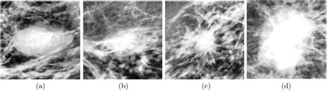 Examples Of Various Benign A B And Malignant C D Lesions From