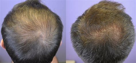 Minoxidil Results After 1 Year Wimpole Clinic