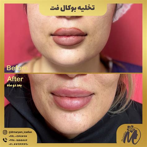 بوکال فت دکتر مریم ایزدیان