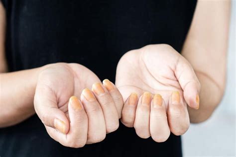 سندرم ناخن زرد چیست؟ از مشکلات ریه تا غدد لنفاوی