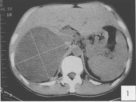 第六节 平滑肌肉瘤 腹部常见病MRI诊断 医学