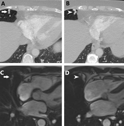 Pavm On Ctpa And Mri Axial Contrast Enhanced Pulmonary Angiography Download Scientific Diagram