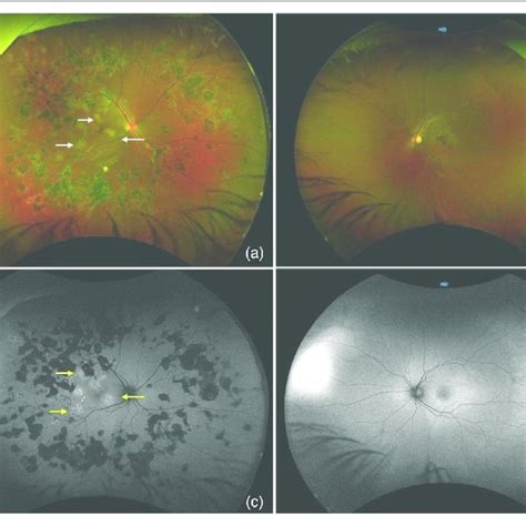 Uwf Fundus Photograph Of Right Eye Showing Active Choroiditis Lesions Download Scientific
