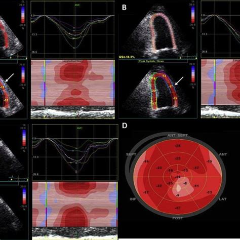 Two Dimensional Myocardial Longitudinal Strain Imaging Showing Reduced Download Scientific