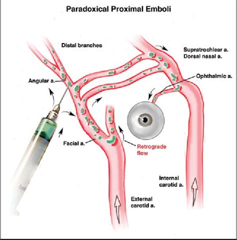 Figure 5 From Complications Of Injectable Fillers Part 2 Vascular