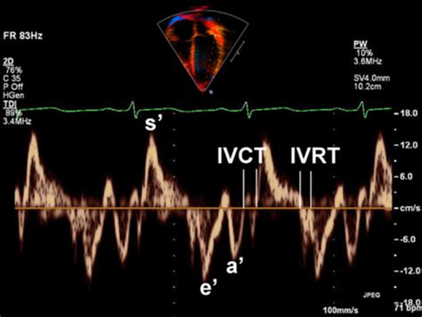 Colour Doppler And Spectral Doppler Flashcards Quizlet