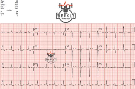 Differential Diagnoses How Hypercalcemia Mimics Stemi Ecg Weekly