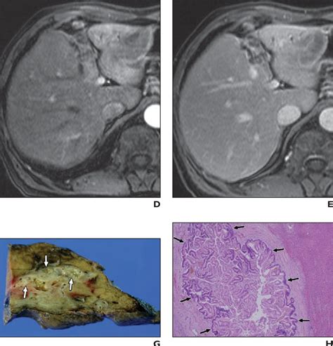 Figure 3 From Differential Ct Features Of Intraductal Biliary