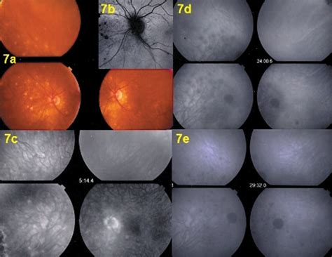 Second Episode Of Choriocapillaritis Consistent With Multifocal Download Scientific Diagram