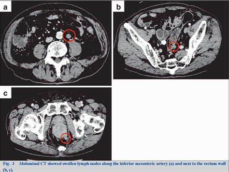 Figure 1 From A Case Of Anorectal Malignant Melanoma With Lymph Node Recurrence Showing A
