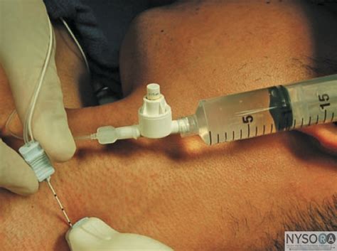 Equipment For Peripheral Nerve Blocks Nysora The New York School Of Regional Anesthesia