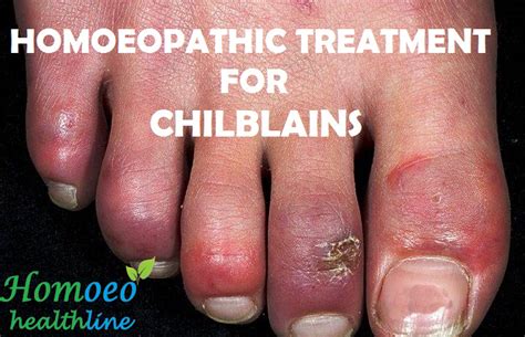 Chilblains And Homoeopathic Treatment
