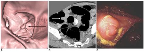A Pseudopolyp At The Appendiceal Orifice In 35 Year Old Asymptomatic Download Scientific