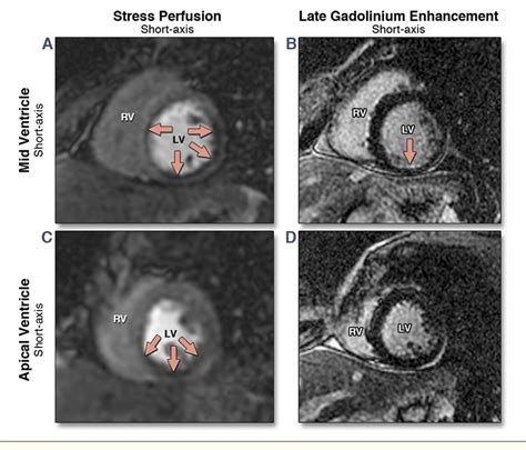 Figure 1 From Stress Myocardial Perfusion Imaging By Cmr Provides Strong Prognostic Value To