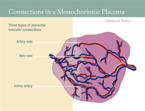 Contemporary Management Of Complicated Monochorionic Twins Journal Of