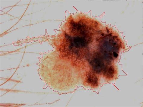 Figure 46 From Analysis Of Lesion Border Segmentation Using Watershed Algorithm Semantic Scholar