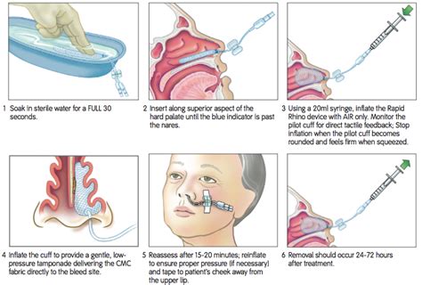 epistaxis icd 10 kierstenilfrank