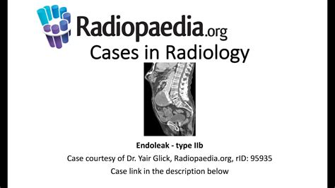 Radiology Endoleak At Ma Lal Blog