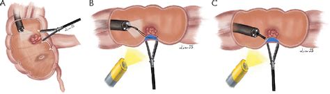 Colon Polyps Removal Surgery