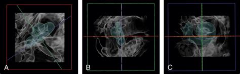 Cochlear Coiling Pattern And Orientation Differences In Coch