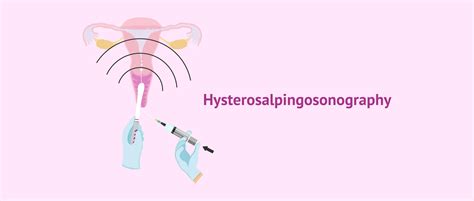 What Is Hysterosalpingosonography Like
