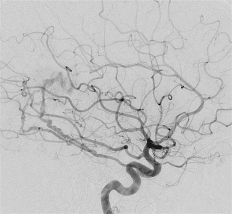 Meningohypophyseal Trunk