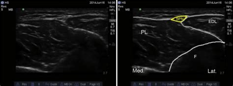Superficial Peroneal Nerve Block