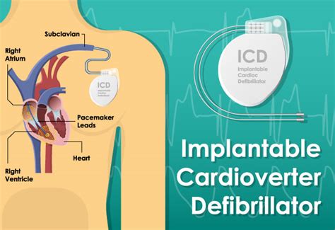 Implantable Cardioverter Defibrillator Vs Pacemaker