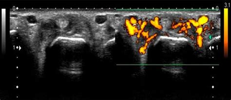 b mode and power doppler ultrasound of the left fourth digit in the download scientific diagram
