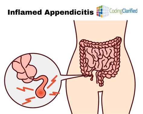 Did You Know That Appendicitis Affects Coding Clarified