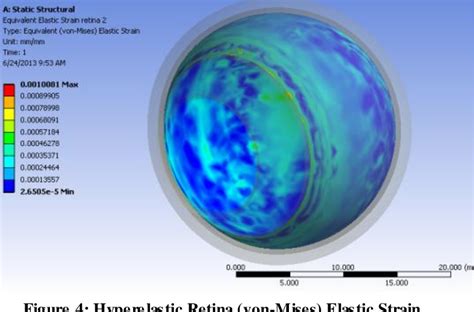 Figure 4 From Design Of Retinal Stent Using Finite Element Analysis