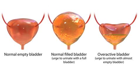 Overactive And Underactive Bladder Urogynecologist Pelvic