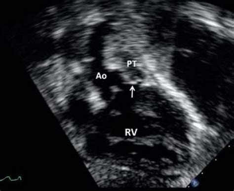 Tetralogy Of Fallot With Pulmonary Stenosis Pulmonary Atresia And Absent Pulmonary Valve