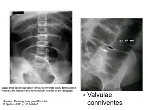 Ileus Obstruction 1pptx