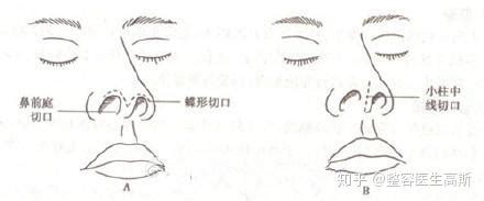 鼻子歪如何矫正3步让鼻子改斜归正 知乎