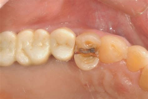 치아 크랙과 치아 파절 Good Dental Clinic