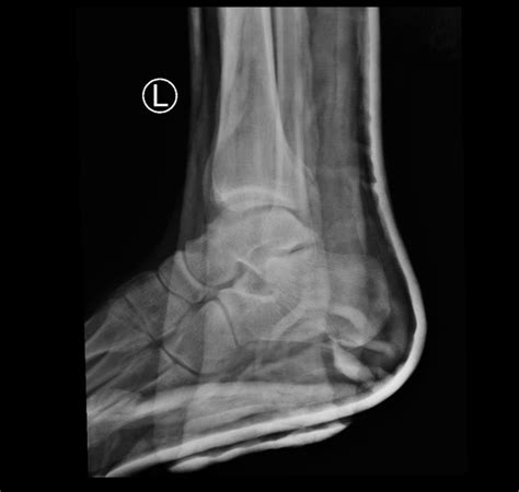 Medial Subtalar Dislocation Post Reduction Xray Lateral Unannotated