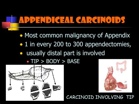 Ppt Carcinoid Tumors Powerpoint Presentation Free Download Id 392880