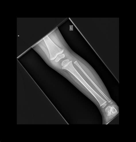 Normal Pediatric Bone Xrays