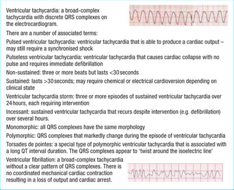 Ventricular Tachycardia Causes Symptoms Diagnosis