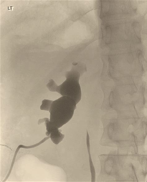 Antegrade And Retrograde Pyelography Download Scientific Diagram