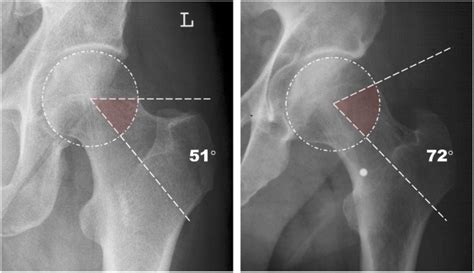 Cam Morphology Is Strongly And Consistently Associated With Development Of Radiographic Hip