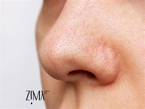 علت ایجاد جوش سرسیاه چیست؟ درمان جوش سرسیاه در خانه زیمالب